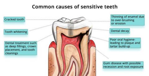 Tooth Sensitivity: Causes, Treatment, and Prevention