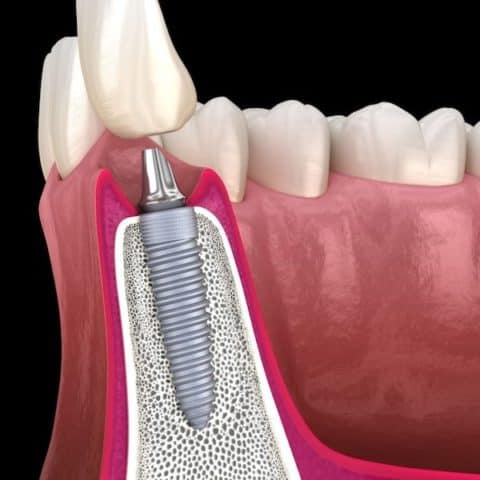 Fixed Prosthesis | Tulsa Dental Center
