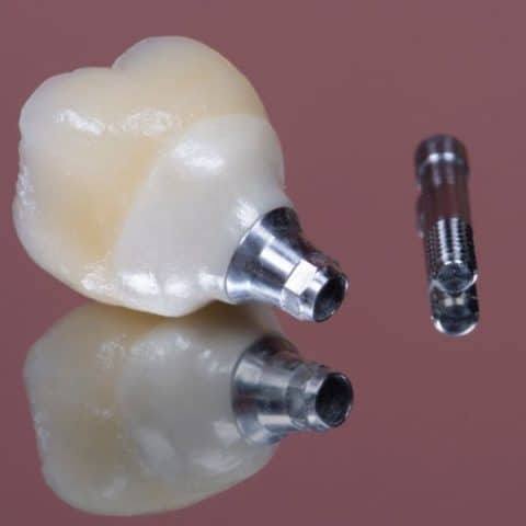 Fixed Prosthesis | Tulsa Dental Center