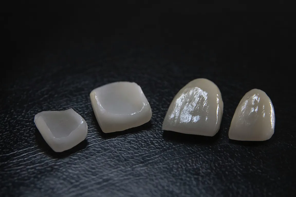How Much Do Veneers Cost? Pricing Guide & Cost Factors | Tulsa Dental ...