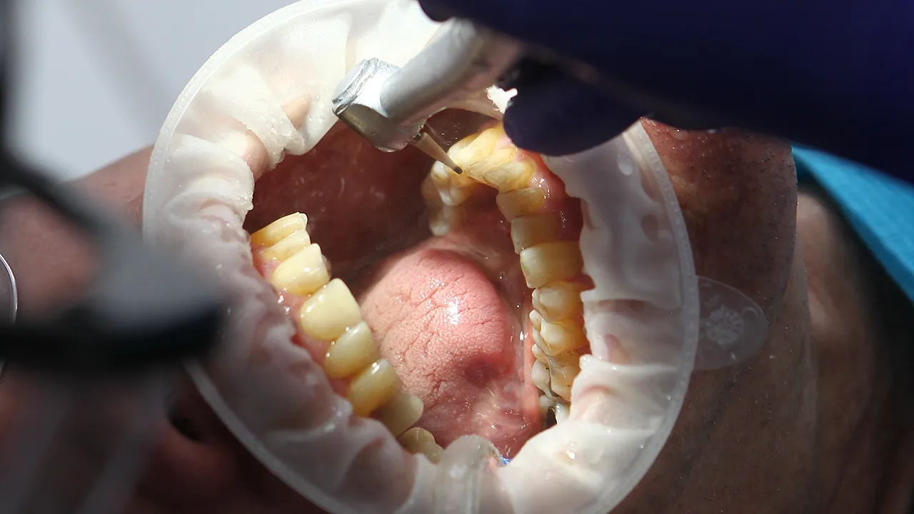 What Does A Cavity Look Like Early Warning Signs You Can T Ignore